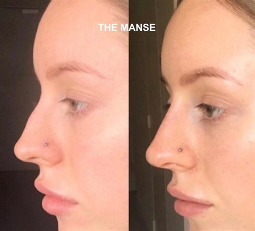 Nose Fillers All You Need To Know - drwongks.com